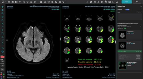 제이엘케이, 뇌 관류영상 분석 AI솔루션 日시장 공략 본격화